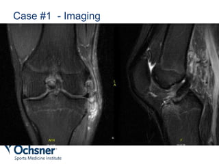 Posterolateral Knee Ligament Reconstruction | PPTX