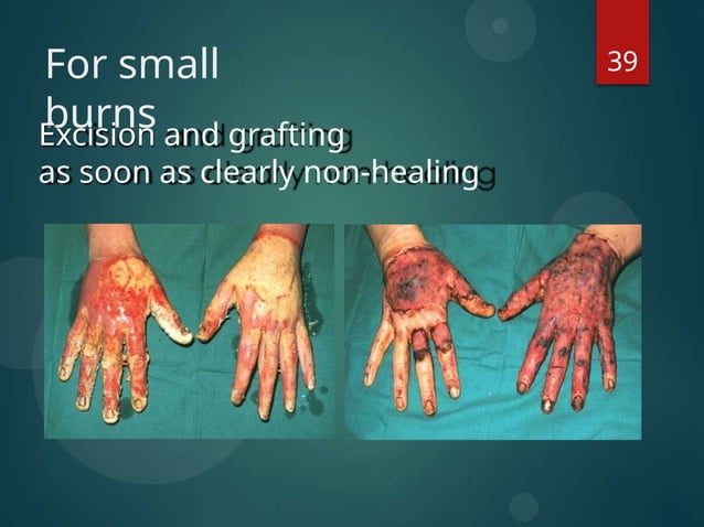 BURN HISTORY,PHYSICAL EXAMINATION OF BURN & PATHOPHYSIOLOGY.pptx