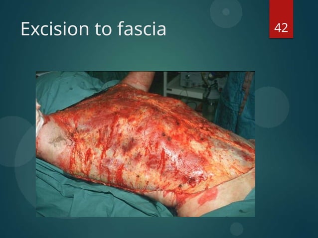 BURN HISTORY,PHYSICAL EXAMINATION OF BURN & PATHOPHYSIOLOGY.pptx