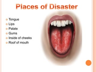 Burning mouth syndrome | PPTX