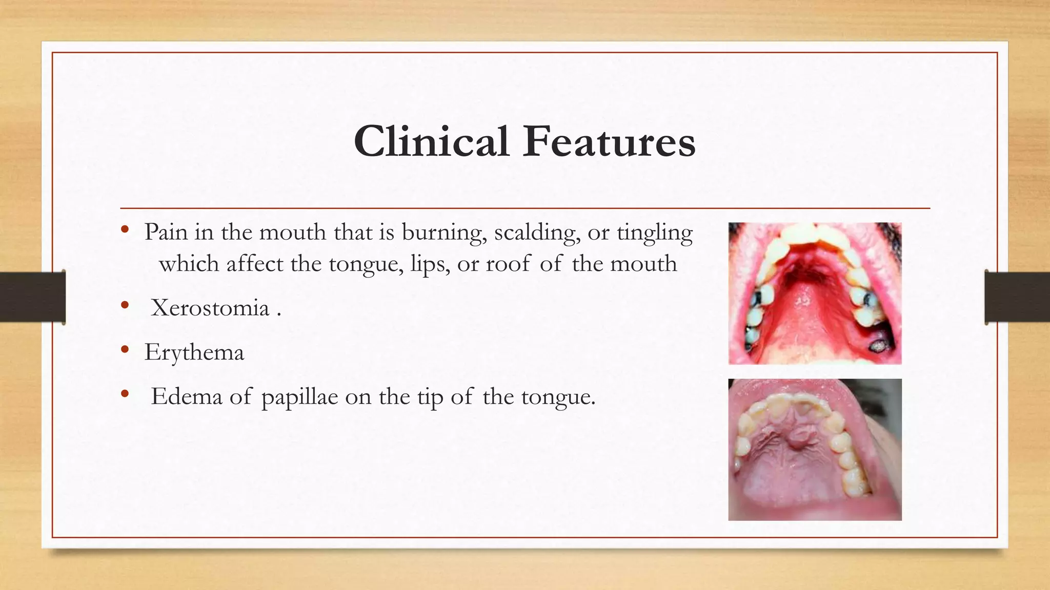 Burning mouth syndrome | PPTX
