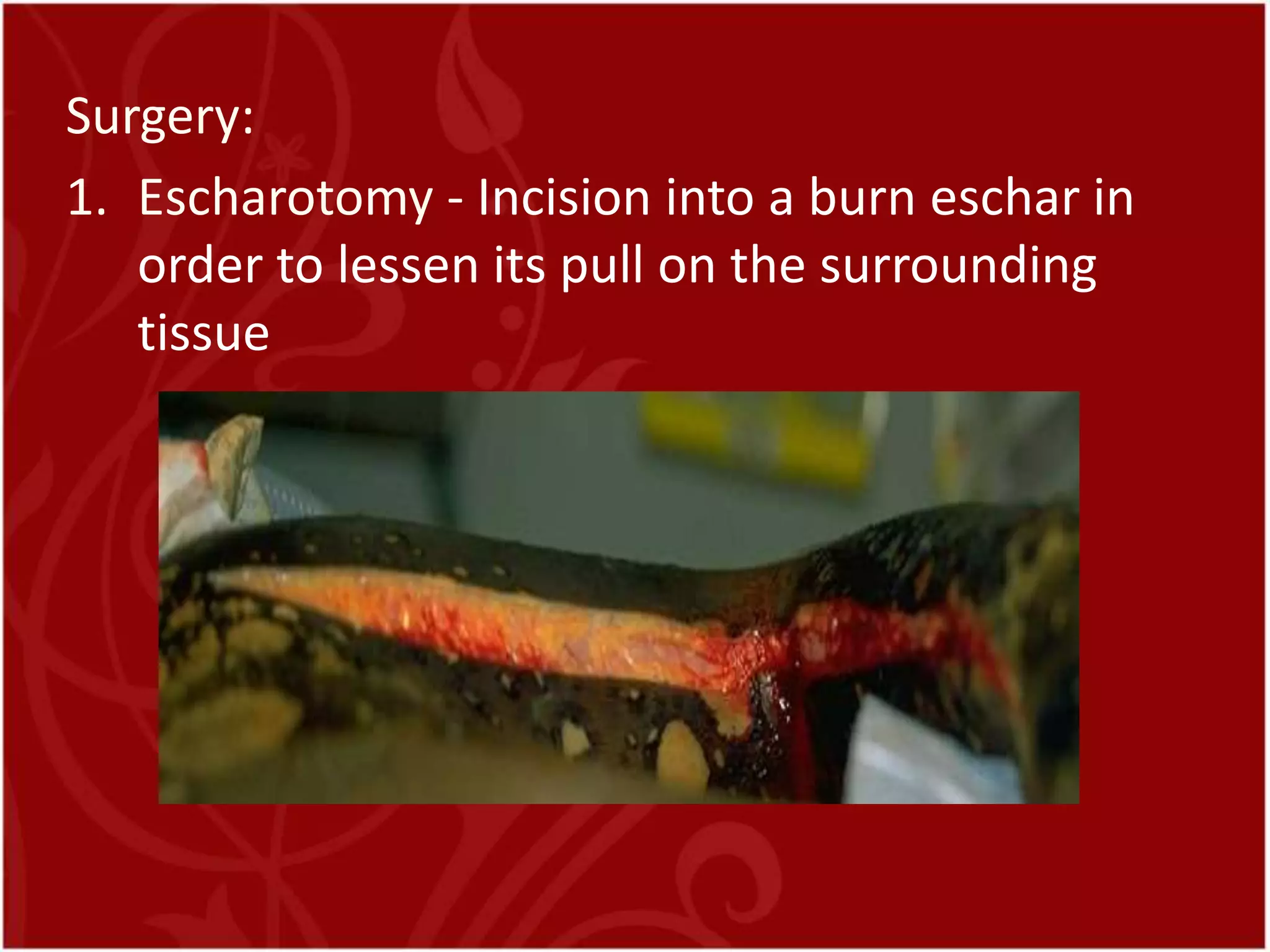 Burn Injuries.ppt