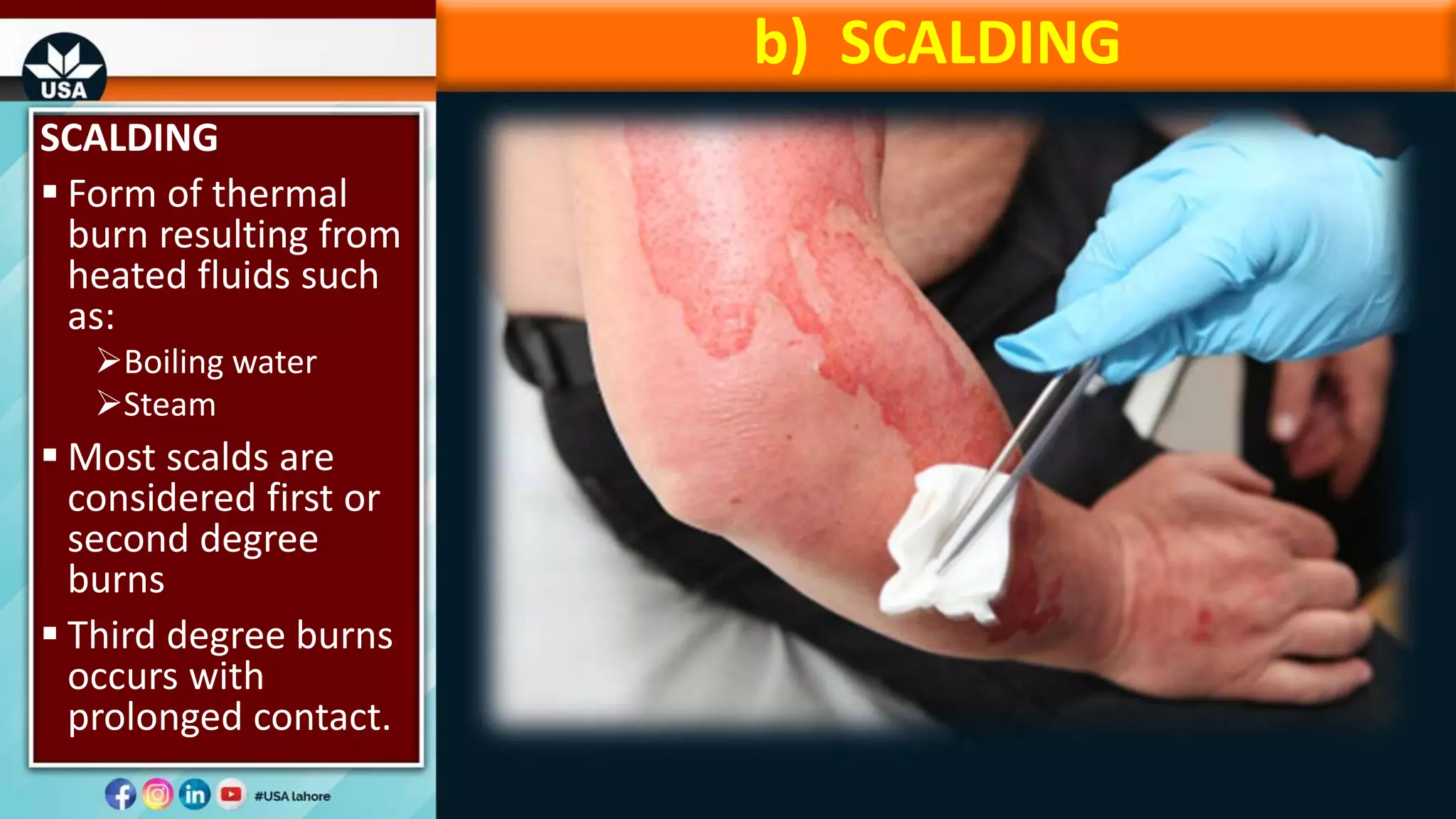 Burn injuries, classification and management | PPTX