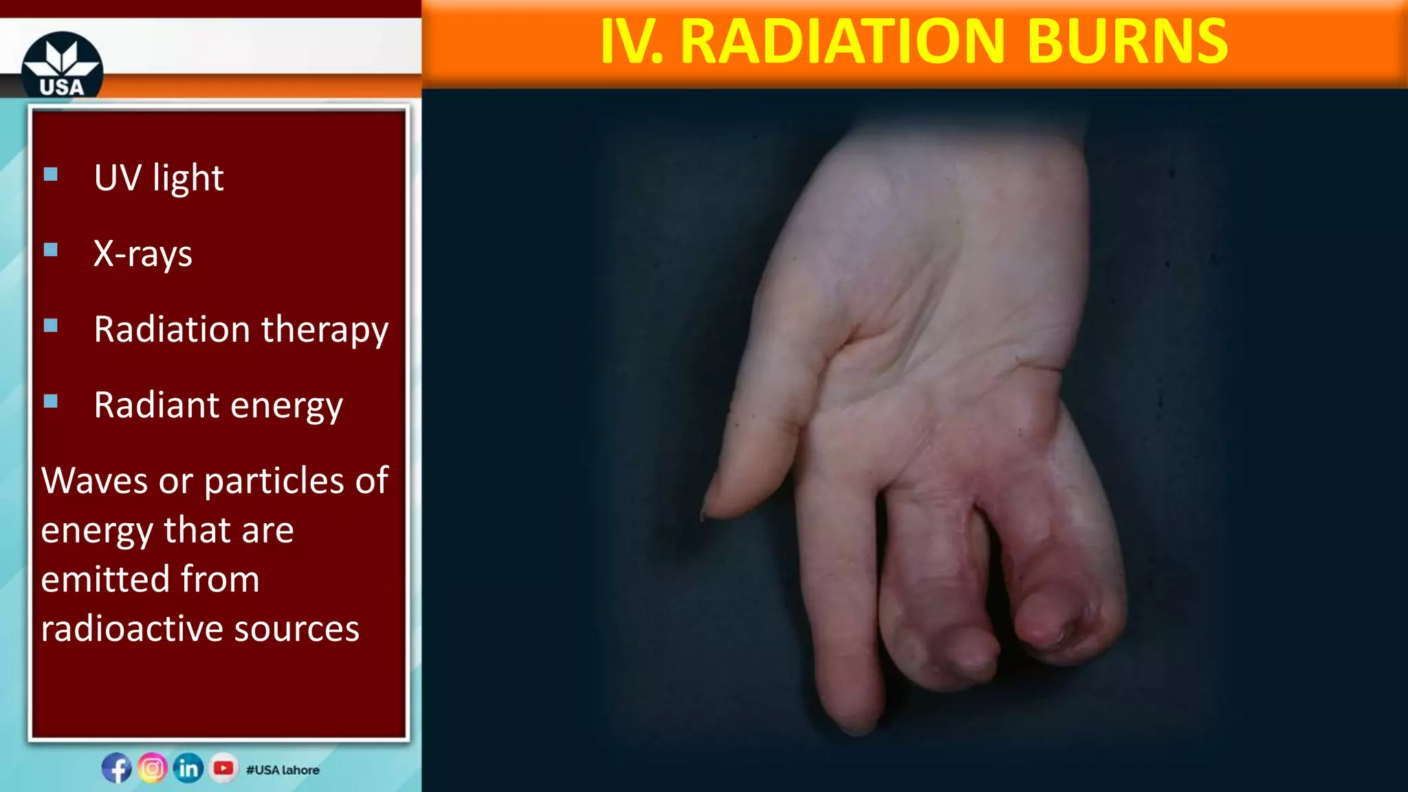 Burn injuries, classification and management | PPTX