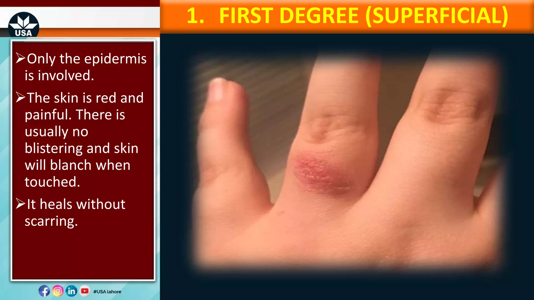 Burn injuries, classification and management | PPTX