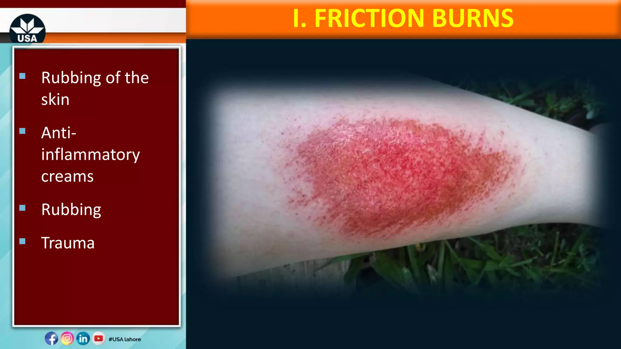 Burn injuries, classification and management | PPTX