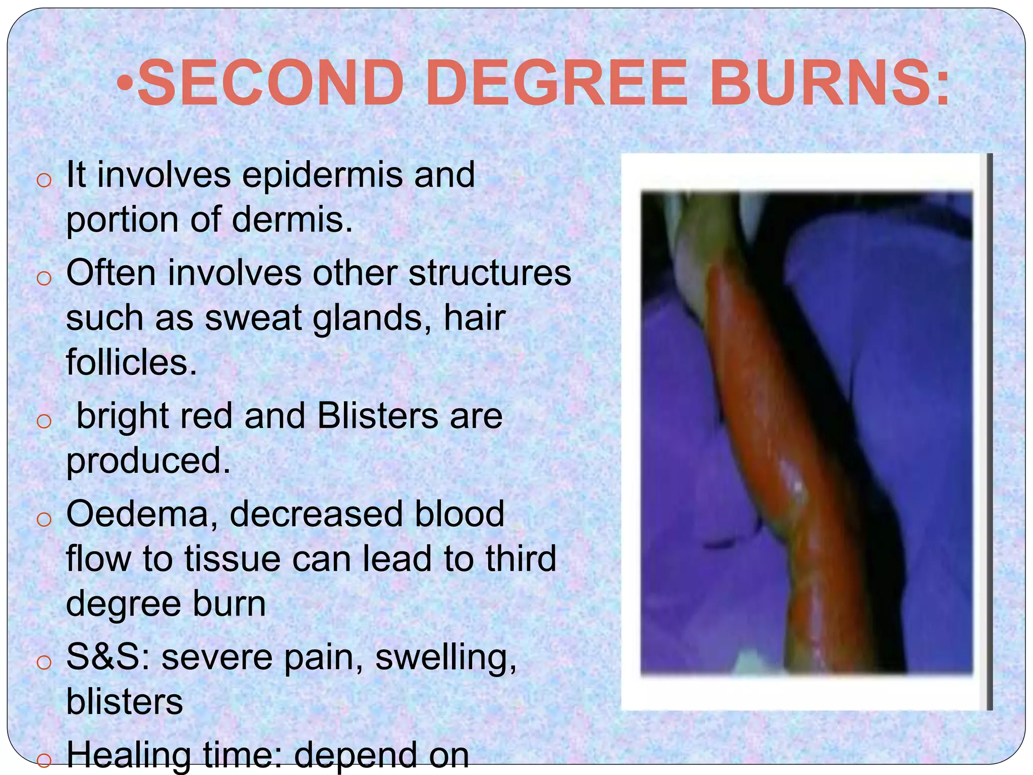 Burn injury | PPTX