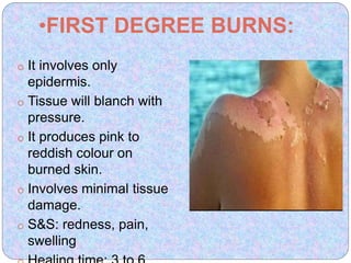 Burn injury | PPTX