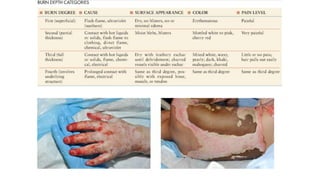 Burn Injury.pptx