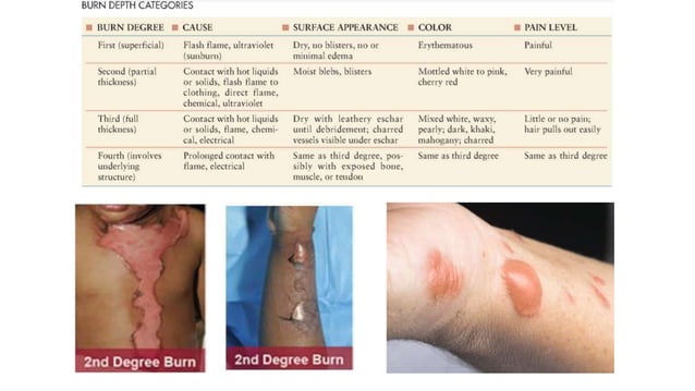 Burn Injury.pptx