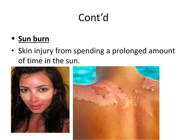 Burn Injury.pptx
