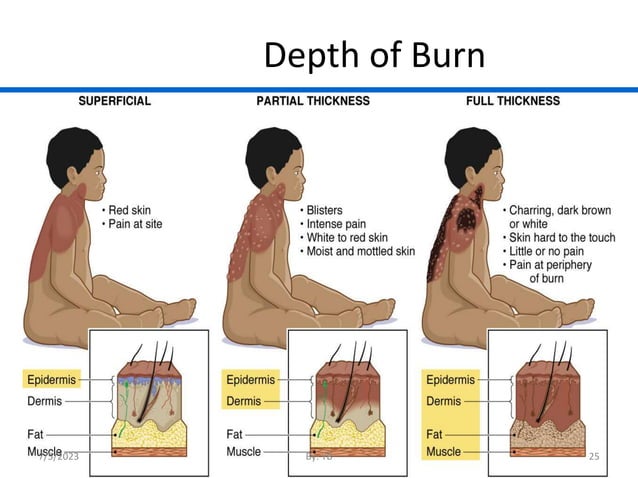 Burn injury for midwife.pptx | Death, Injury, or Military Conflict ...