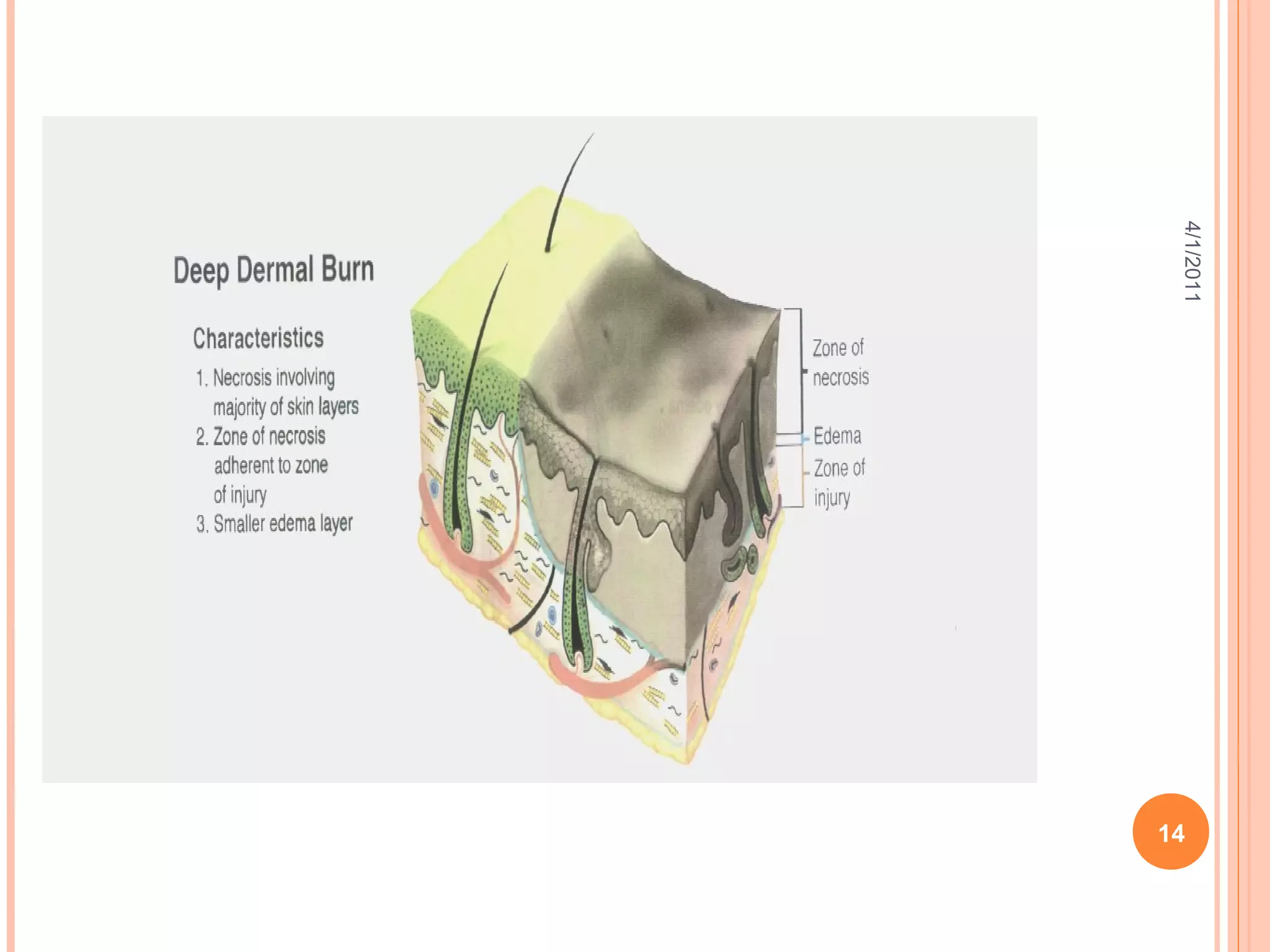 Burn Injuries and Its Management | PPT