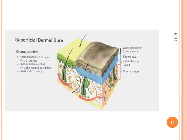 Burn Injuries and Its Management | PPT