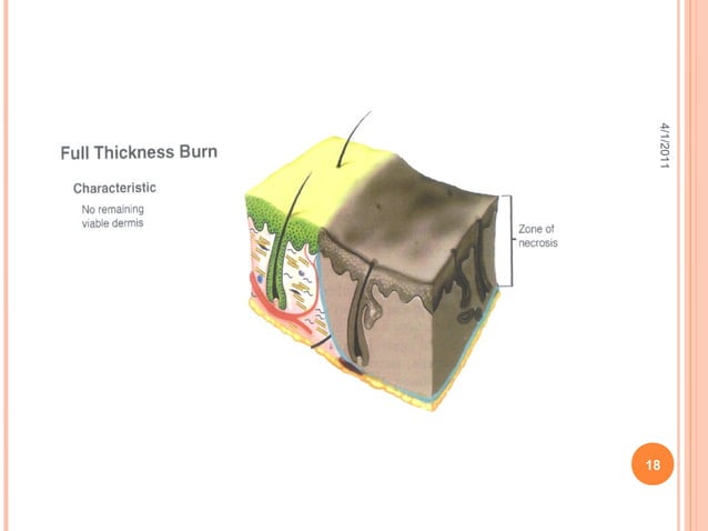Burn Injuries and Its Management | PPT