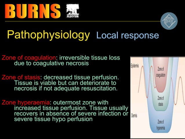 Burn management | PPT