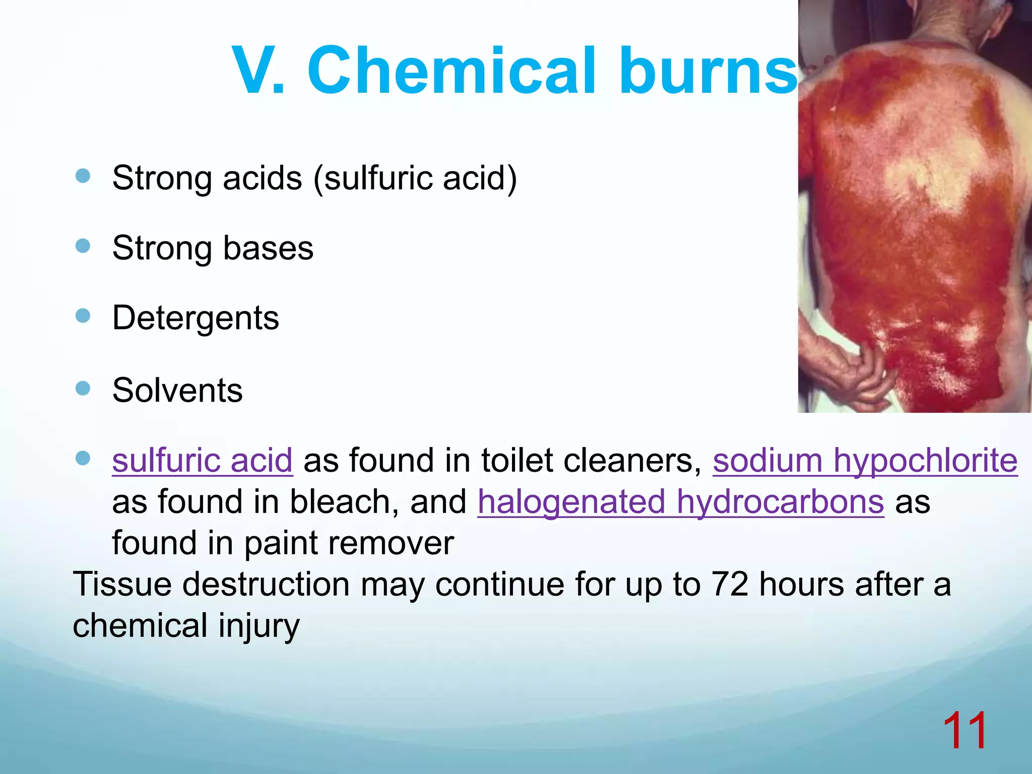 Burn management | PPTX
