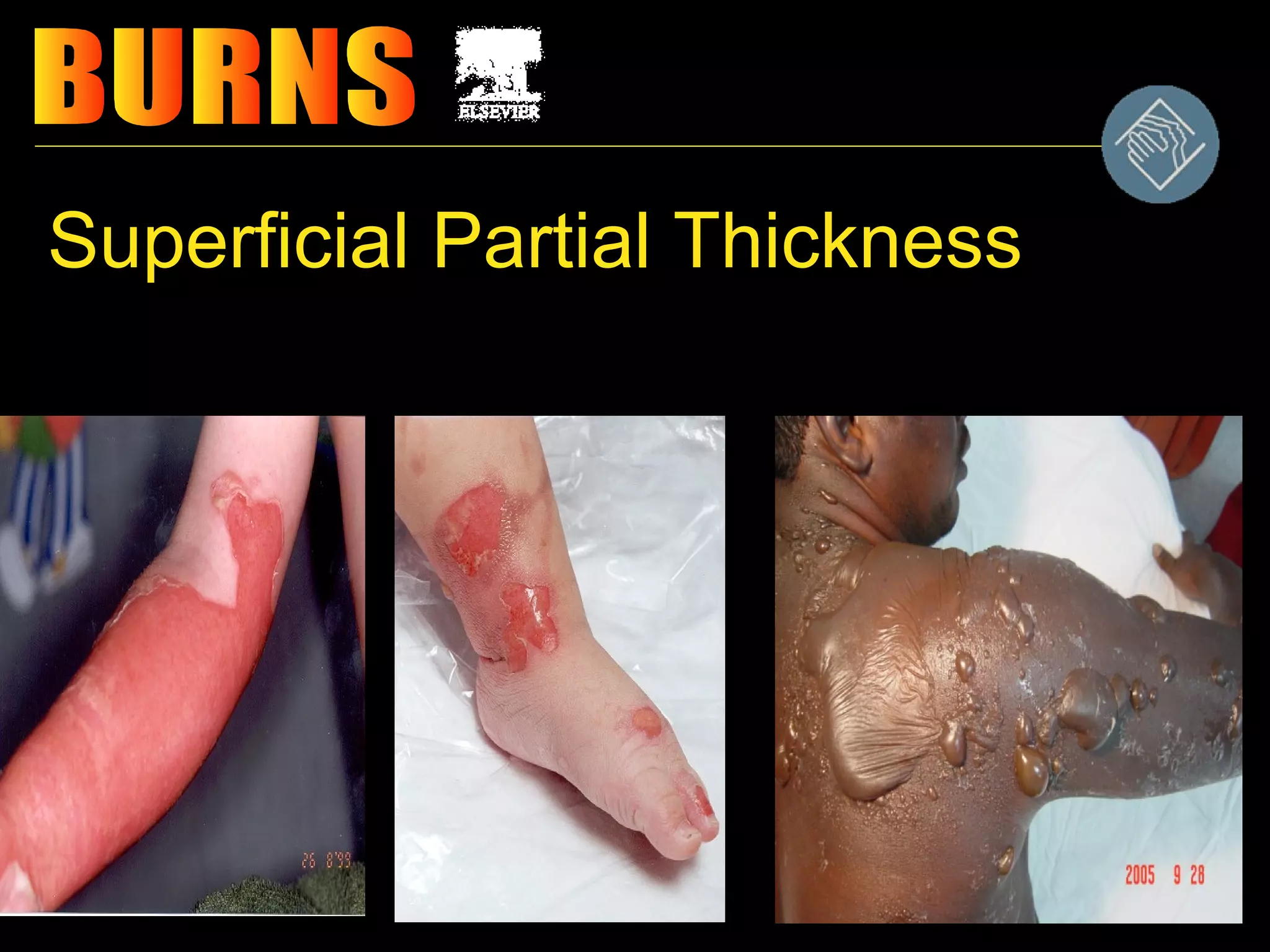 Burn management Dr.Mahmoud Ameen | PPT