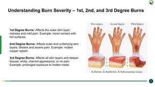 Burn Prevention & Response_AQC.pptx training | PPTX