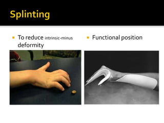 Burn rehabilitation | PPTX