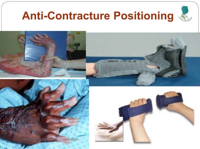 Burn Rehabilitation Ppt