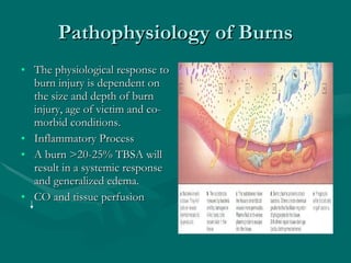Burns | PPT
