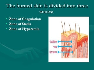 Burns | PPT