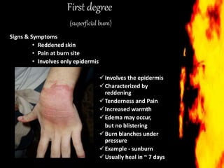 Burns | PPT