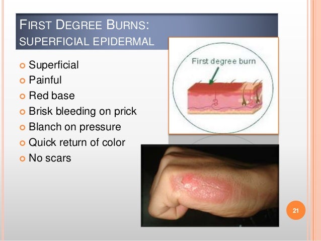 Burn Injury Typess Classification Causes Assesment and Managment