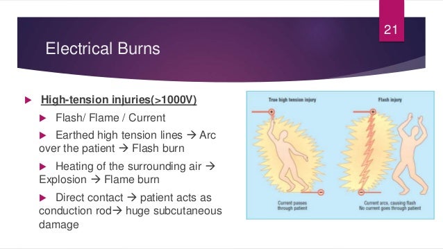 Burns - Pathophysiology, Evaluation and Management