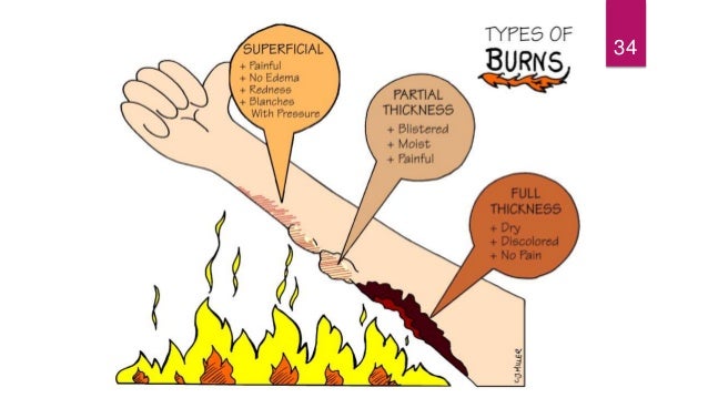 Burns - Pathophysiology, Evaluation and Management