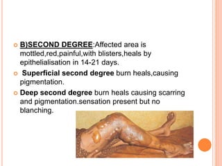 Burns | PPTX