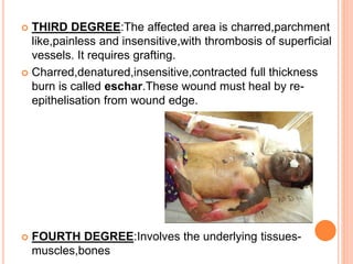 Burns | PPTX