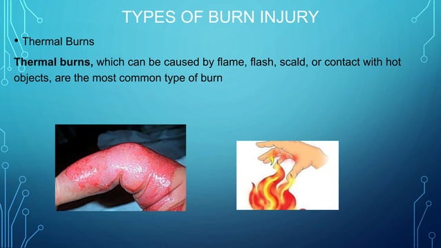 Burns | PPTX | Skin and Dermatology | Diseases and Conditions