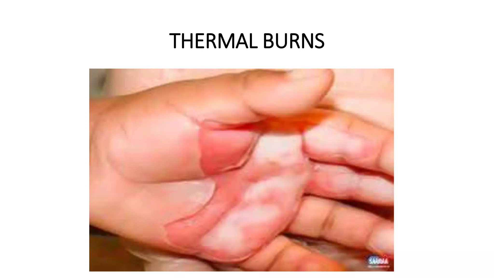 Burns | PPTX