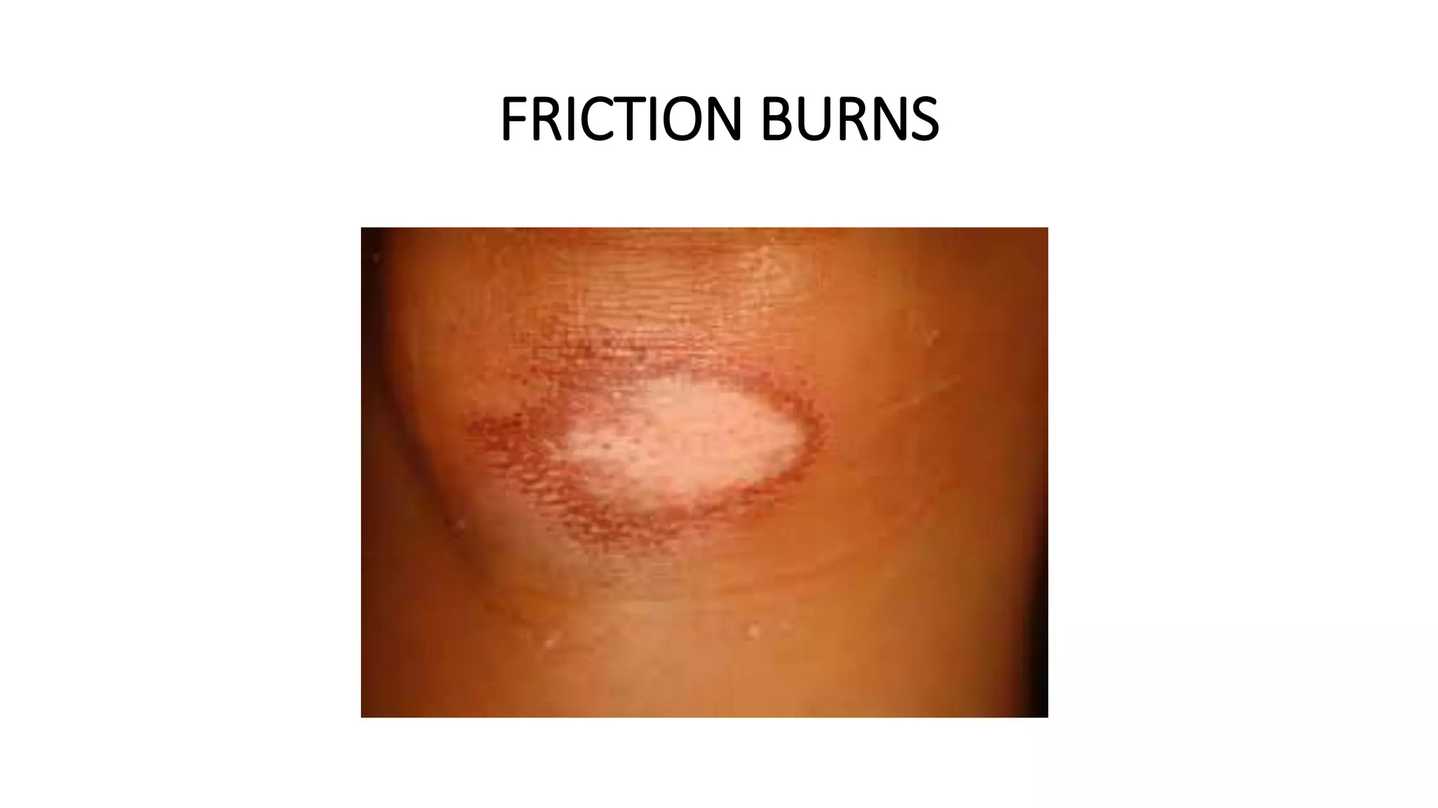 Burns | PPTX