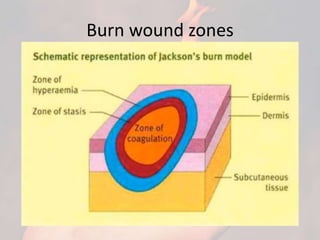 Burns | PPT