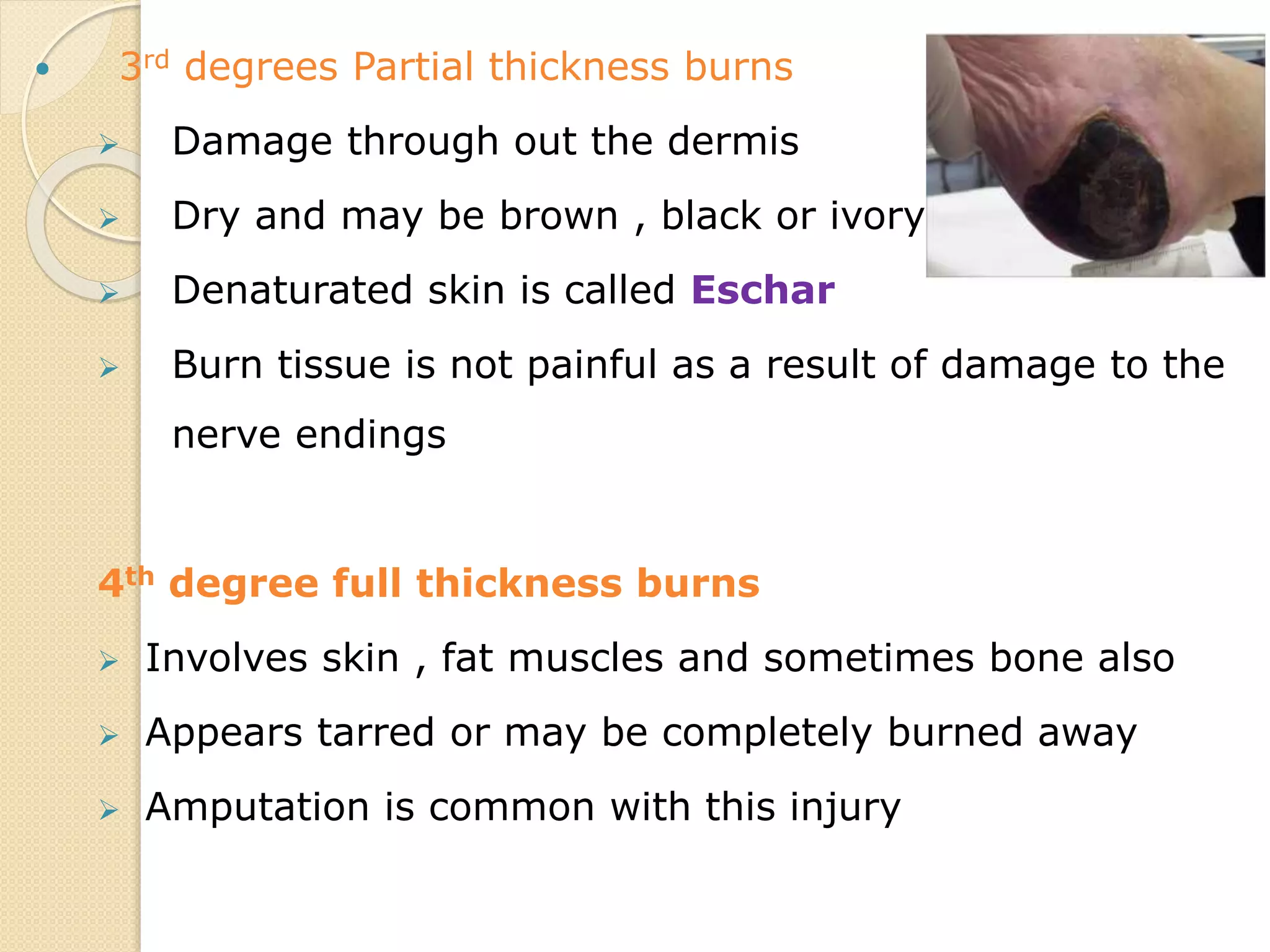 Burns and its management | PPTX