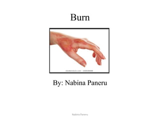 Burns | PDF