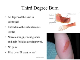 Burns | PDF
