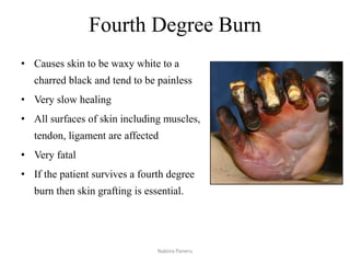 Burns | PDF