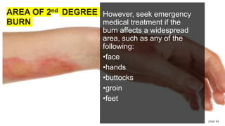 Burn burn to human body | PPT
