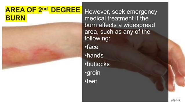 Burn burn to human body | PPT