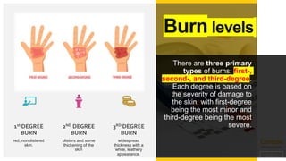 Burn burn to human body | PPT