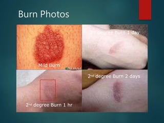 Burns.pptx