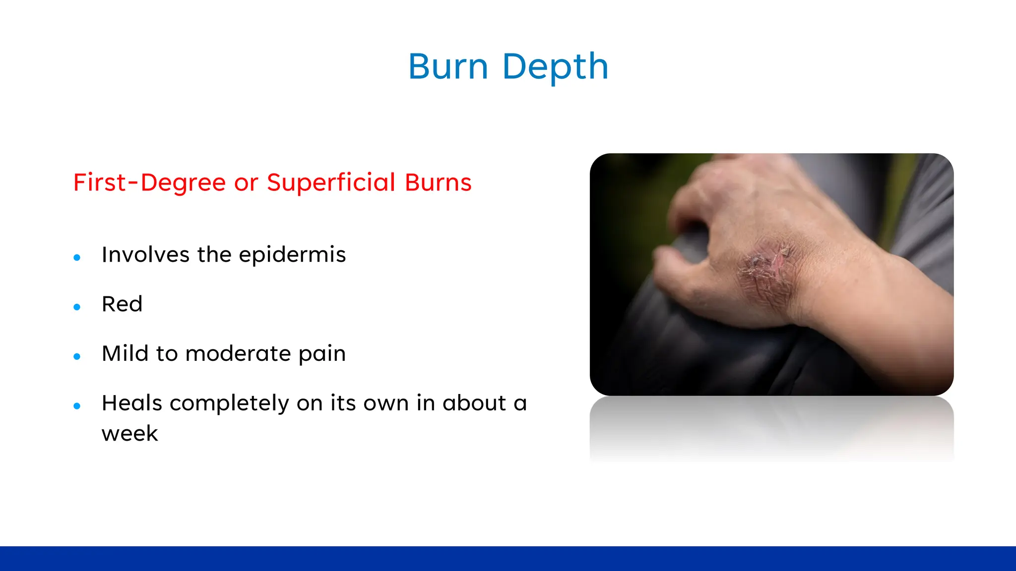 A Guide to First Aid for Burns which include the types of burns and the ...