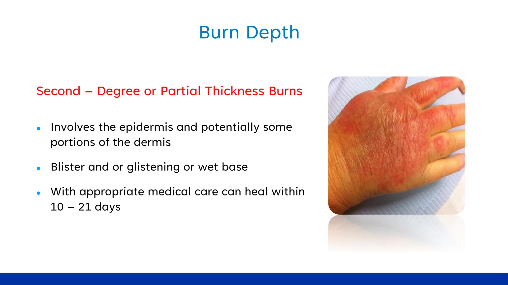 A Guide to First Aid for Burns which include the types of burns and the ...
