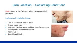 A Guide to First Aid for Burns which include the types of burns and the ...