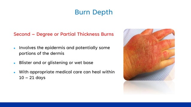 A Guide to First Aid for Burns which include the types of burns and the ...