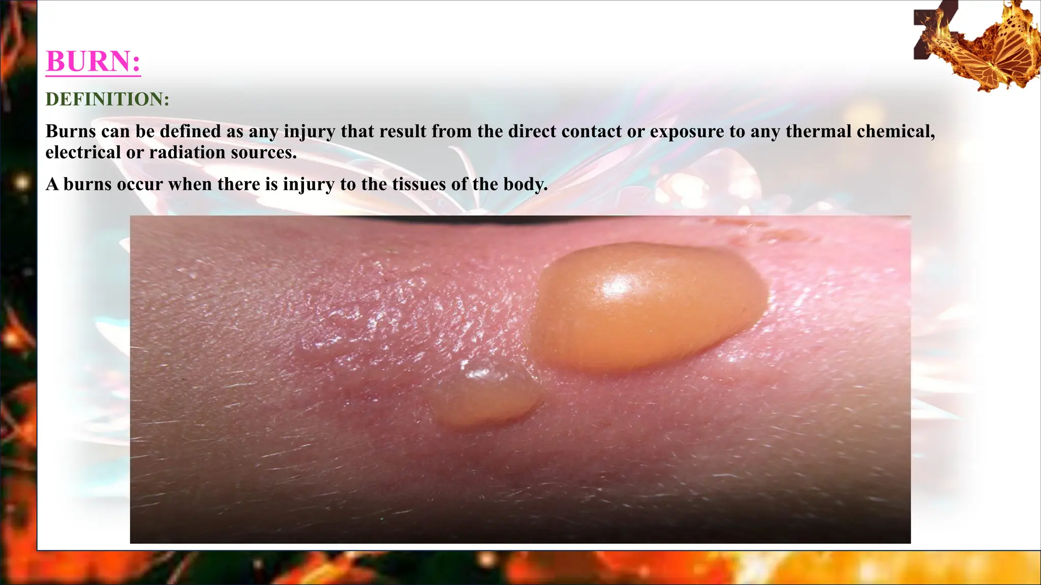 BURNS, CALCULATION OF BURNS, CALCULATION OF FLUID REQUIREMENT AND ...